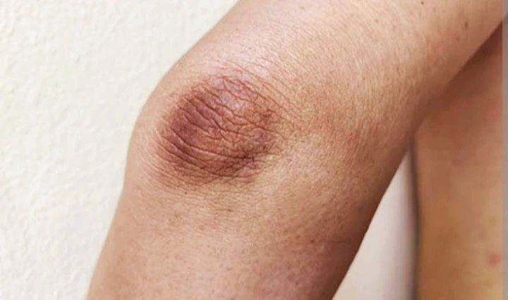 DARK KNUCKLES: Causes And Remedies For Hyperpigmentation √√ The Scoper ...